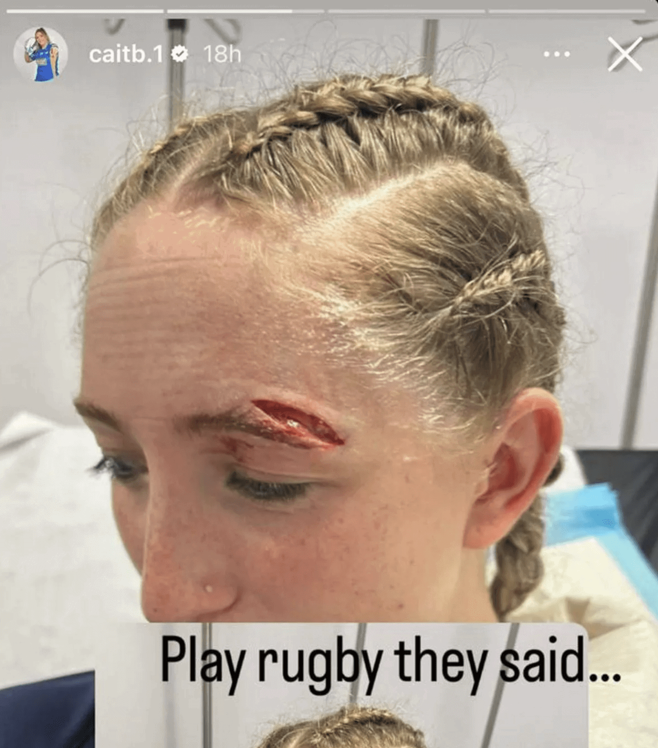 Leeds Rhinos star Caitlin Beevers suffers horrendous facial injury ...